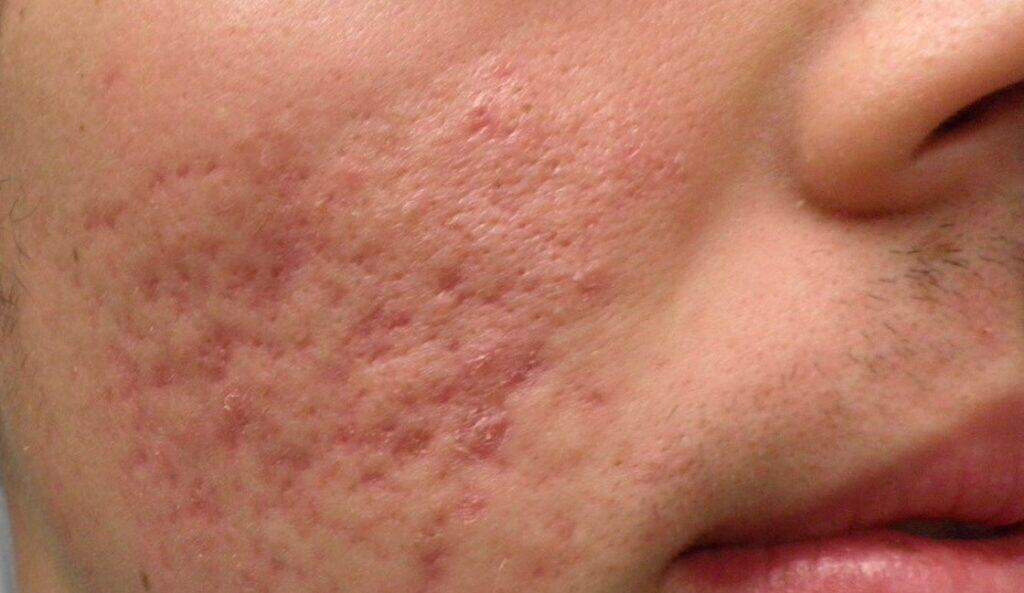 Advanced Cosmetic Medicine - Skin Care Clinic Adelaide (ACM)