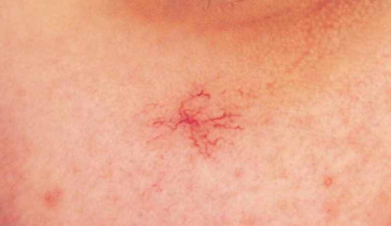 Spider Nevus Treatment Adelaide - ACM Laser Clinic